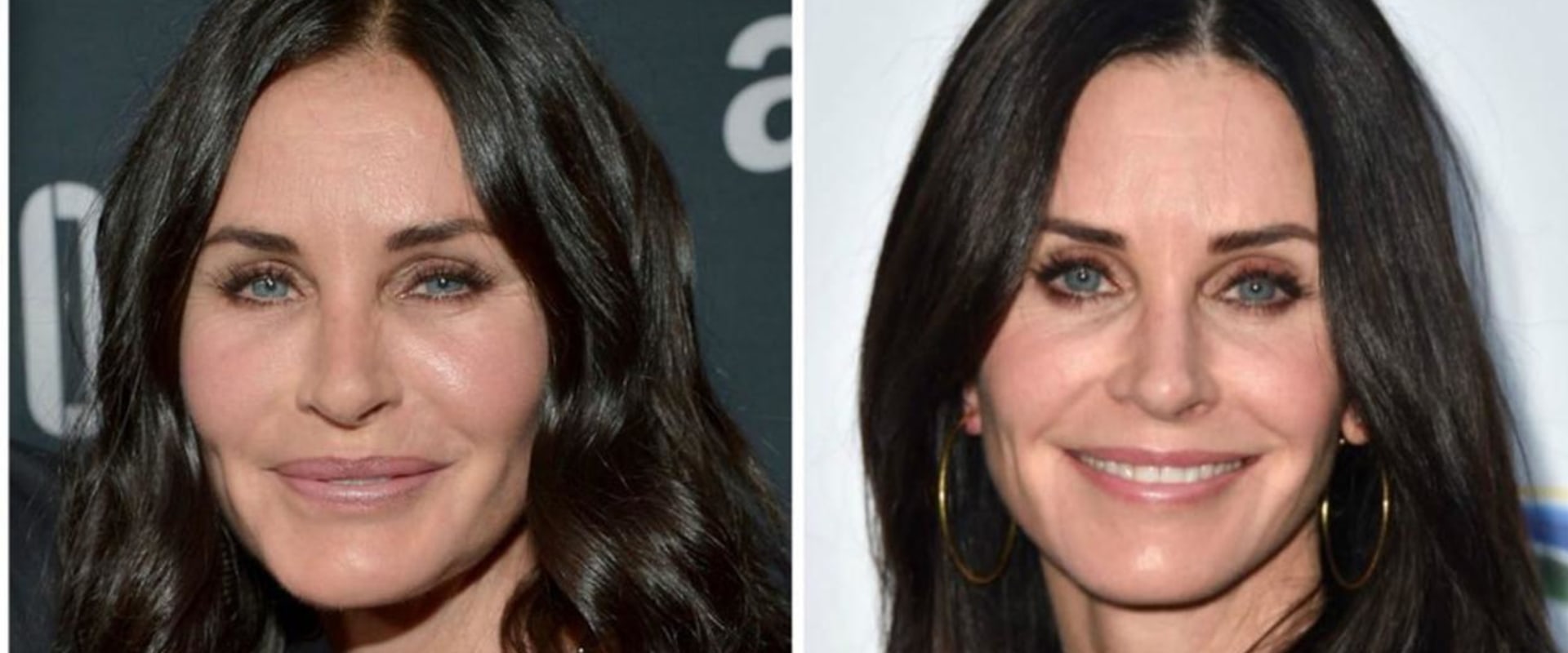 Everything You Need to Know About Dissolving Facial Fillers