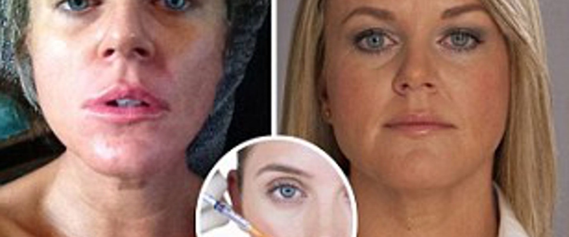 What Happens to Your Face When Fillers Disappear?