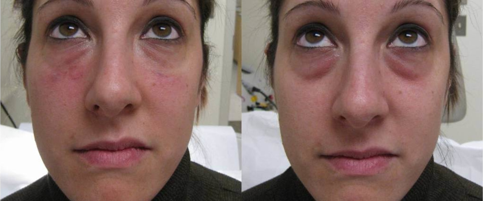 When to Get Facial Fillers: A Guide for Men and Women